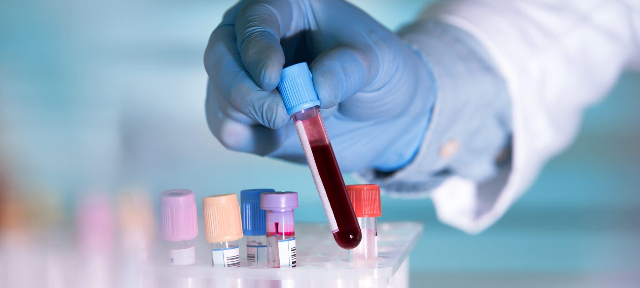 FDA Clears Revolutionary Blood Test for Alzheimer's: Krieger Klein ...